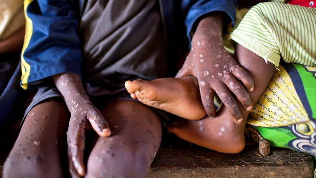 Inbound Travellers To Fill Health Form Due To Monkeypox - West Africa ...